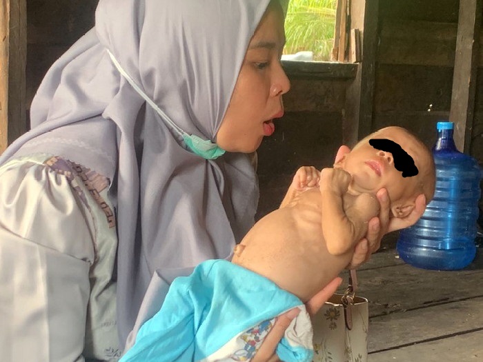 Satu Bayi Perempuan di Aceh Singkil Alami Gizi Buruk